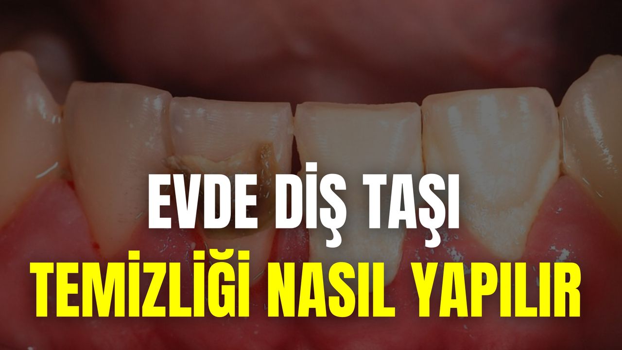 Evde Diş Taşı Temizliği Nasıl Yapılır - Urfa Haberleri