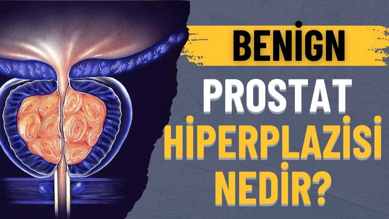 Benign Prostat Hiperplazisi Nedir? - Urfa Haberleri