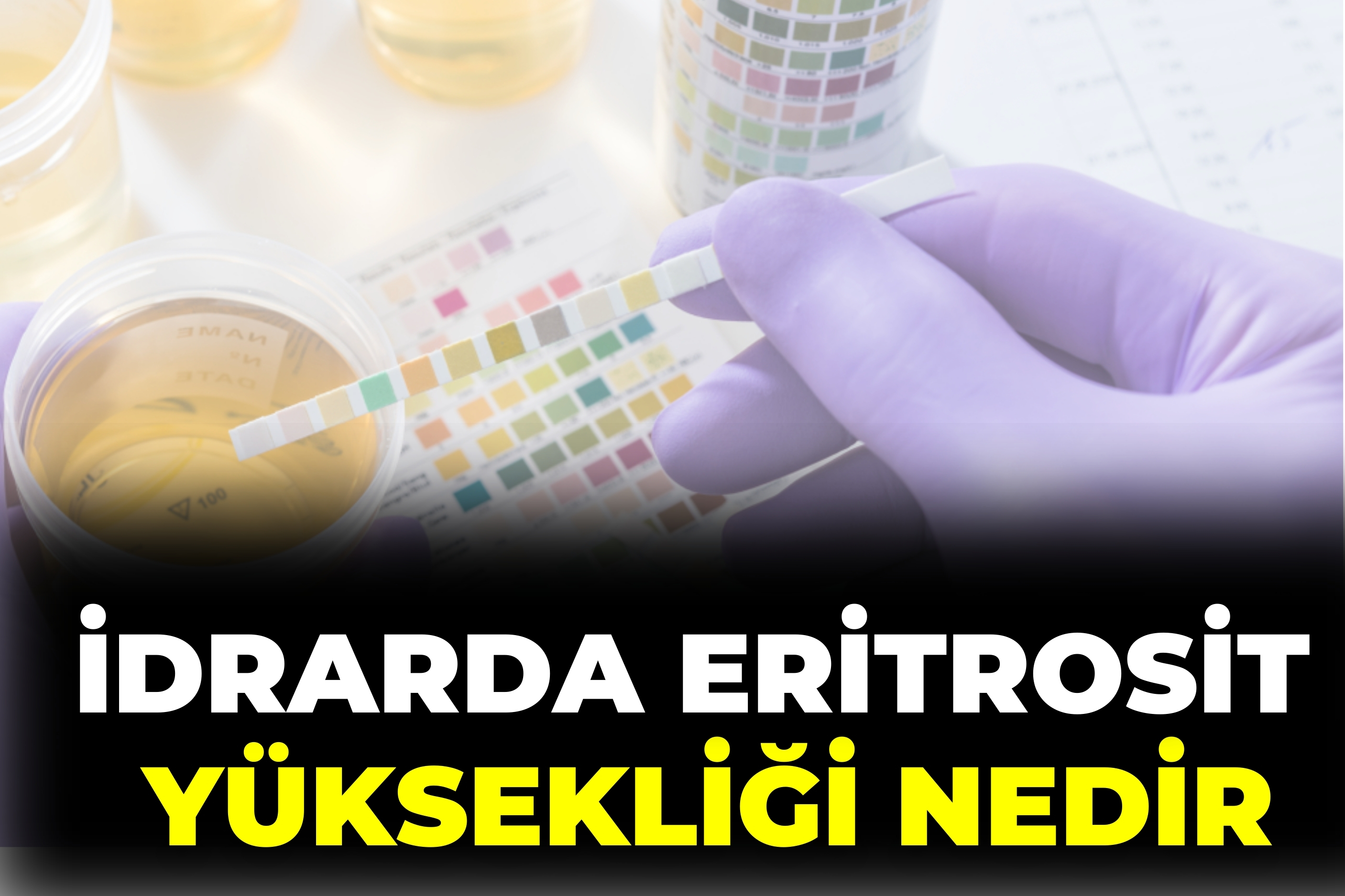İdrarda Eritrosit Yüksekliği Nedir - Urfa Haberleri