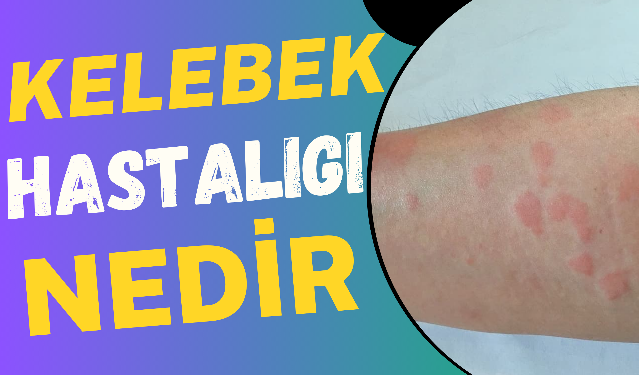 Kelebek Hastaligi Nedir - Urfa Haberleri