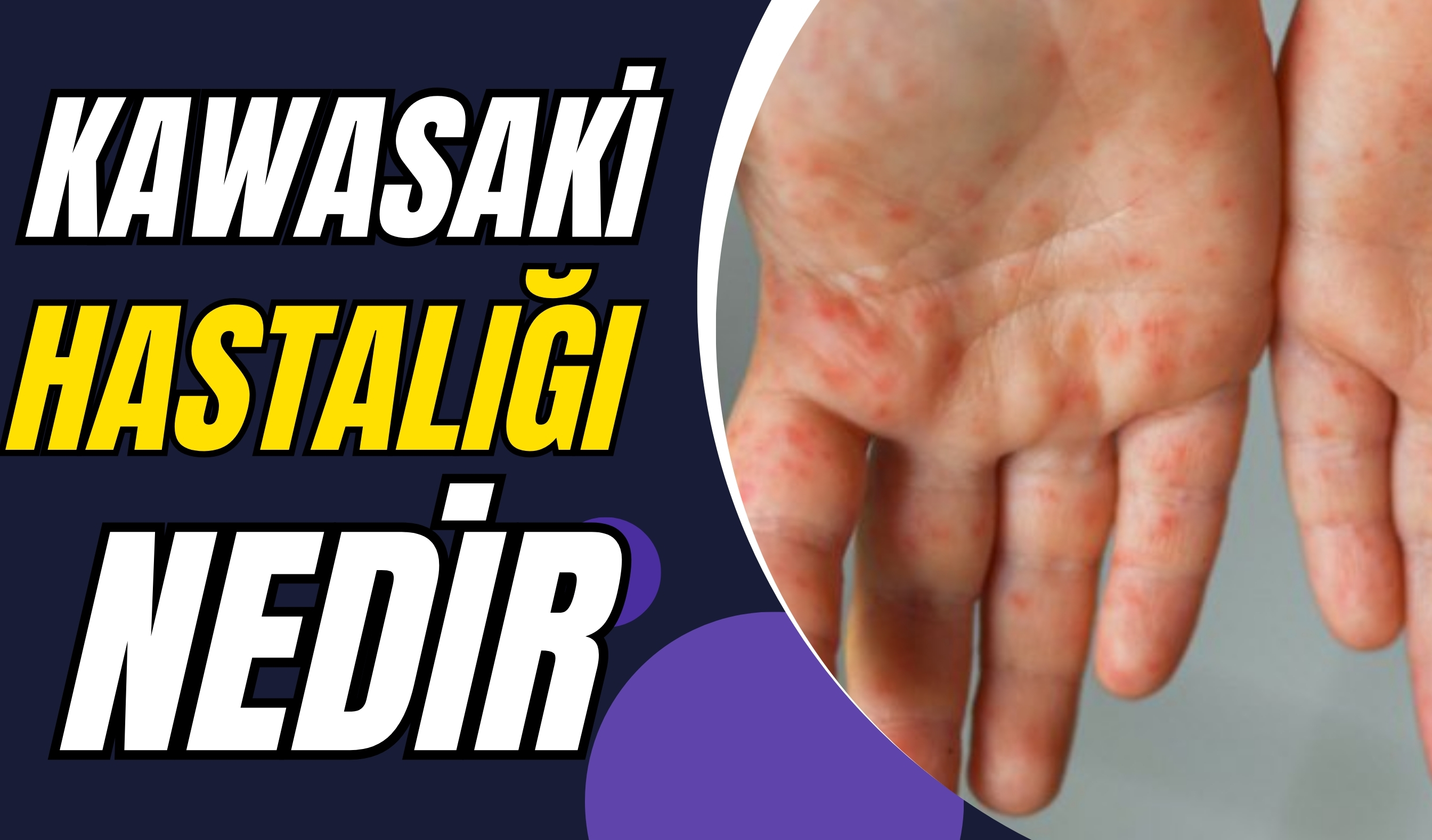 Kawasaki Hastalığı Nedir - Urfa Haberleri